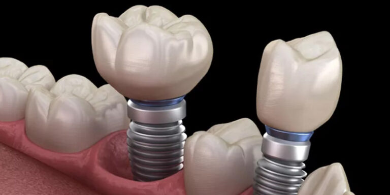 Impianti Dentali - Titanium Dent